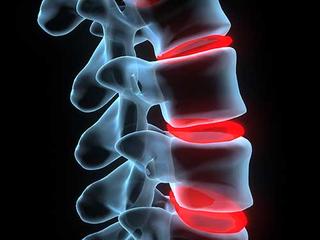 Understanding Herniated Disc Signs & Symptoms | Triangle Spinal ...