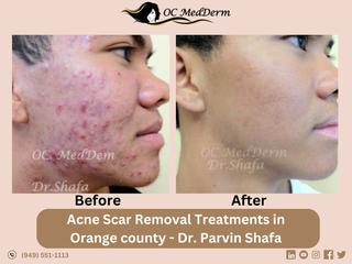 Acne Scar Removal Treatments in Orange county - Dr. Parvin Shafa ...