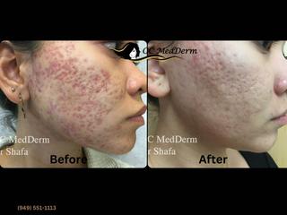 Co2 Laser acne scar doctor in Orange county, CA - Dr. Parvin Shafa ...