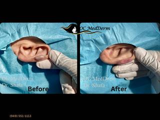 Cosmetic Ear Lump Removal in Irvine CA - OC MedDerm | Shafa Parvin Inc ...