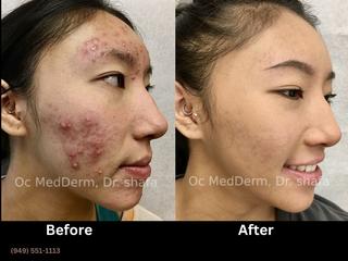 How Nutrition Plays a Role in Acne Treatment Results | Irvineskin | OC ...