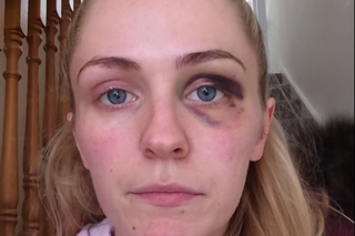 How to Treat Black Eye | Urgent Care- Astrahealth Center in Belleville ...